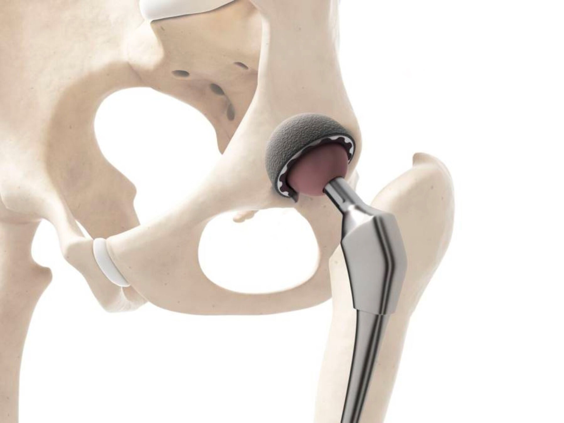 Tratamiento de Cadera en Tijuana - Traumatologo Ortopedista en Tijuana